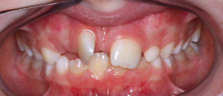 Before / After – Pickering & Allen Orthodontics