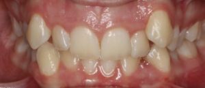 Before / After – Pickering & Allen Orthodontics